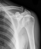 Posterior Shoulder Dislocation: Radiographic Evidence - CanadiEM