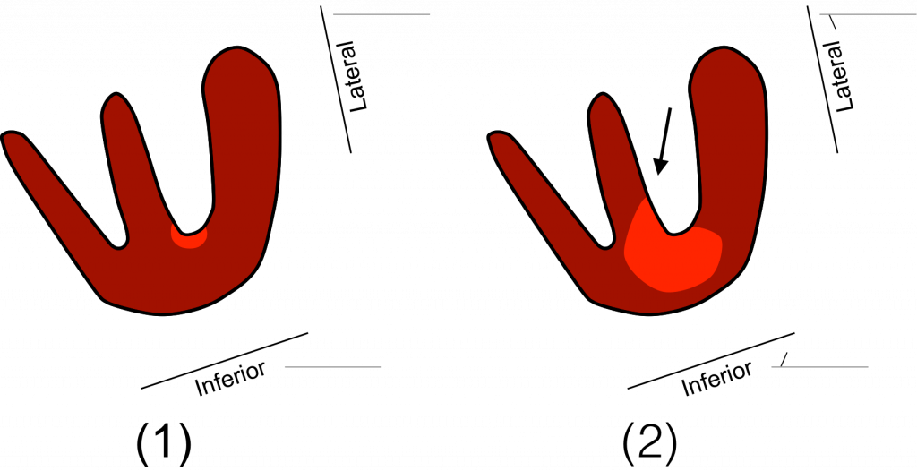 The Boring Guide to ECG's: Fascicular blocks - CanadiEM