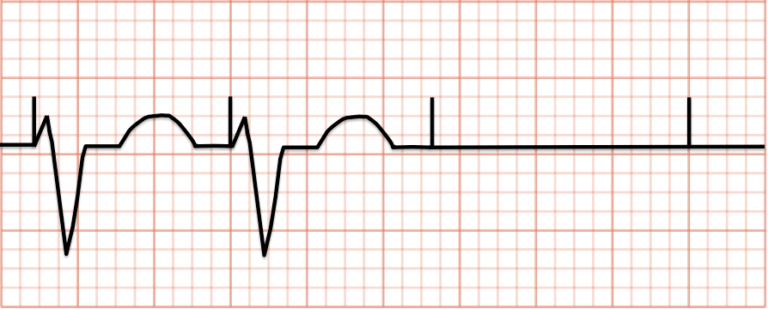 Pacemaker Essentials: How to Interpret a Pacemaker ECG - CanadiEM