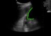 Clinical Ultrasonography 101: Where Right Upper Quadrant Scans Go Wrong ...