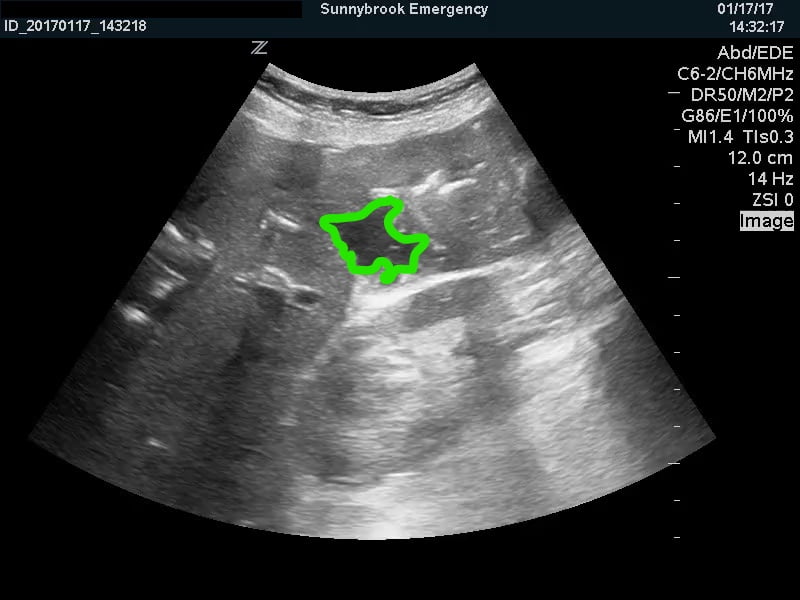 Clinical Ultrasonography 101: Where Right Upper Quadrant Scans Go Wrong ...