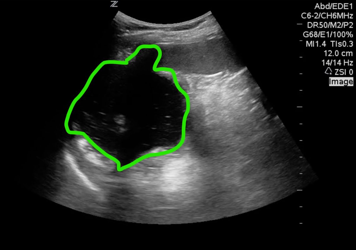 Clinical Ultrasonography 101: Where Right Upper Quadrant Scans Go Wrong ...