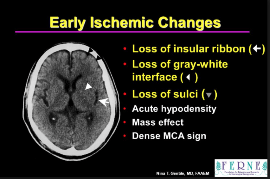 CRACKCast E101 – Stroke - CanadiEM