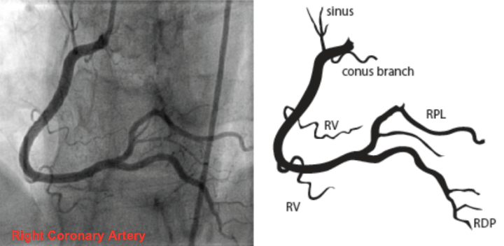 Sirens to Scrubs: Acute Coronary Syndromes, Part Four – Spot the Lesion ...