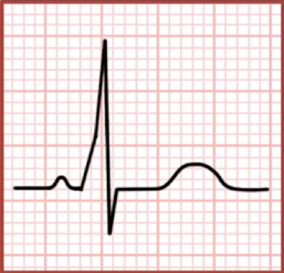 Sirens to Scrubs: Wolff-Parkinson-White Syndrome - CanadiEM