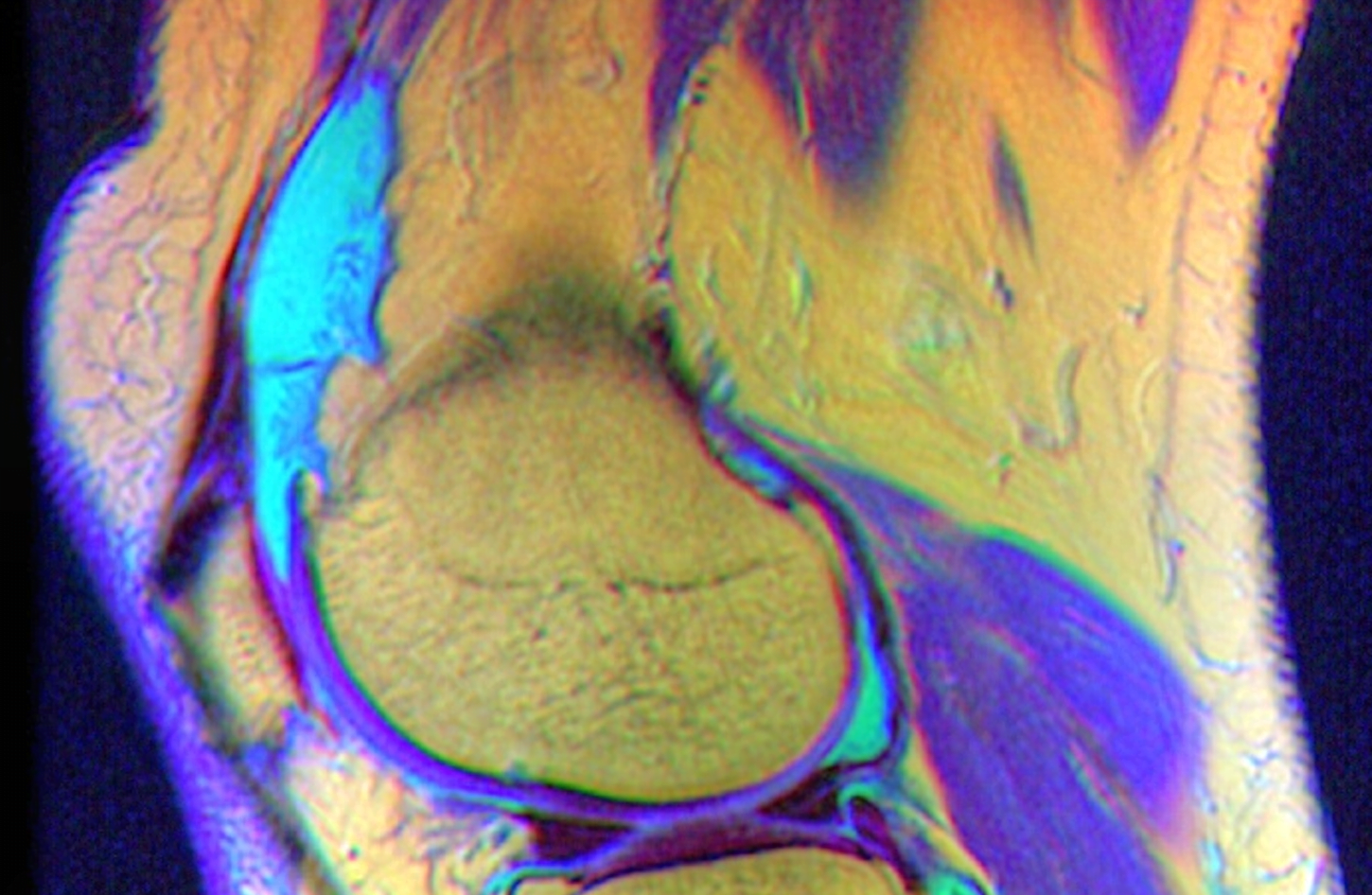Busting Assumptions about the Suprapatellar Bursa - CanadiEM