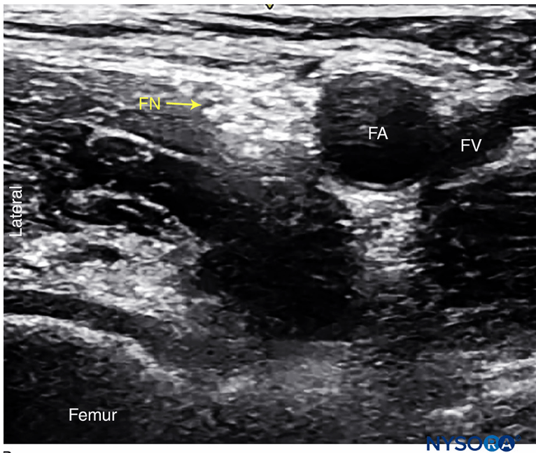 Hip Nerve Block Toolkit - CanadiEM