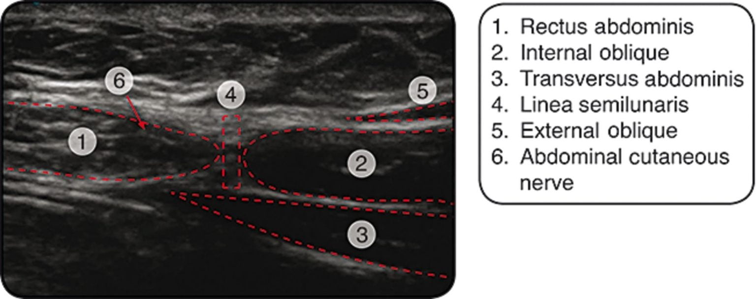 Abdominal Cutaneous Nerve Entrapment Syndrome (ACNES): A Not-So-Rare ...