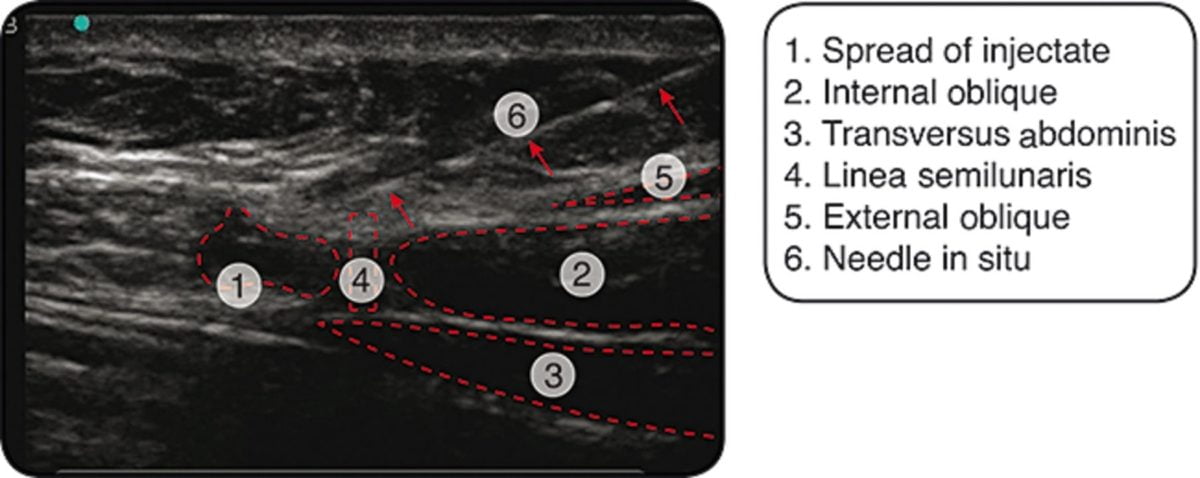 Abdominal Cutaneous Nerve Entrapment Syndrome (ACNES): A Not-So-Rare ...