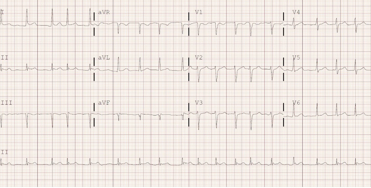 When Guidelines Conflict: Managing Atrial Fibrillation in the ED - CanadiEM